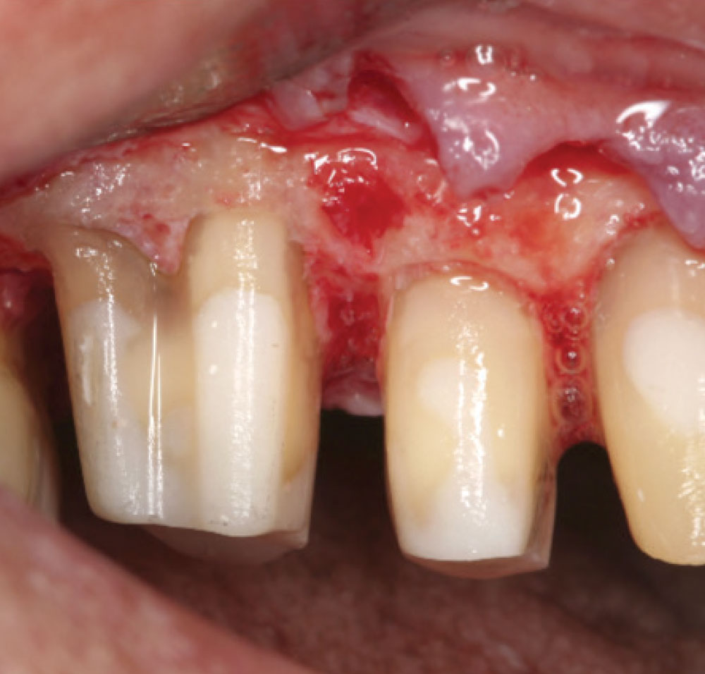 cm0601-photo-essay-closed-flap-crown-lengthening-20