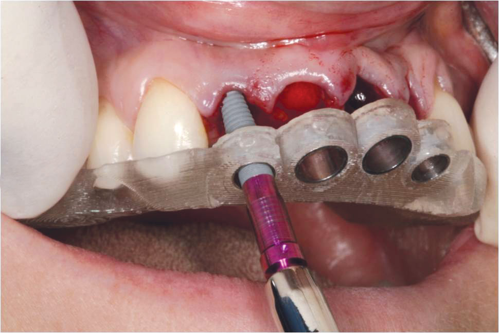 im0102-optimizing-implant-placement-12