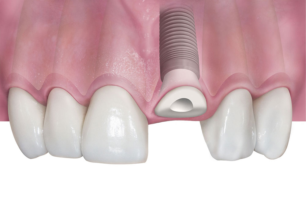 implant-considerations-02