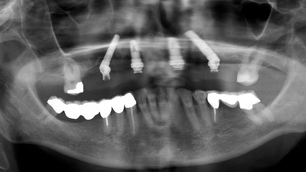 im0501-multi-unit-abutments-05