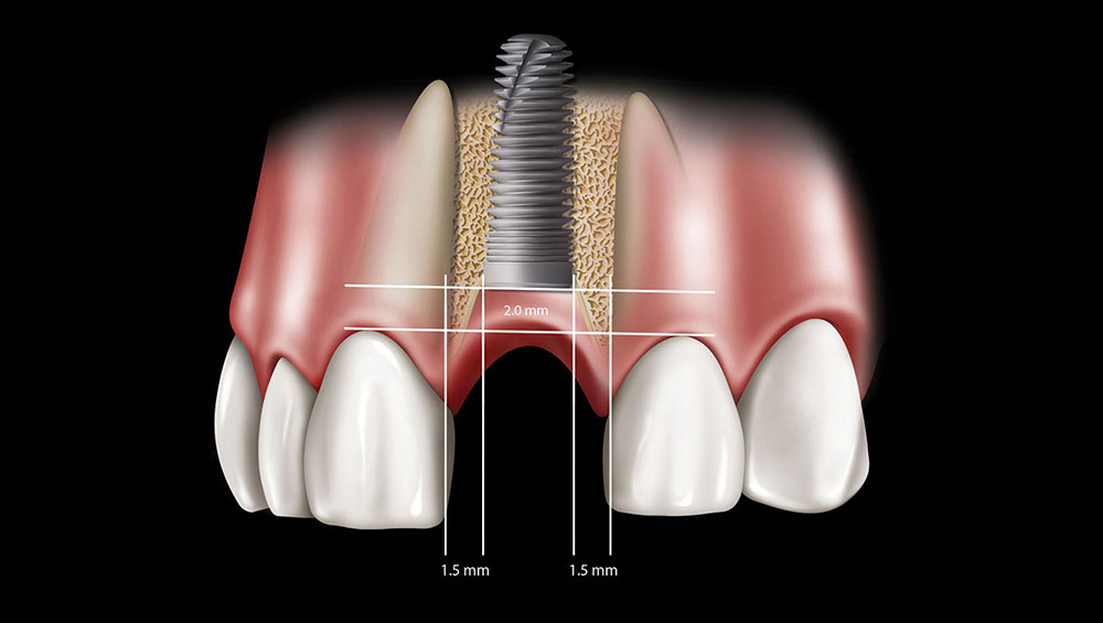 im0303-implant-position-04