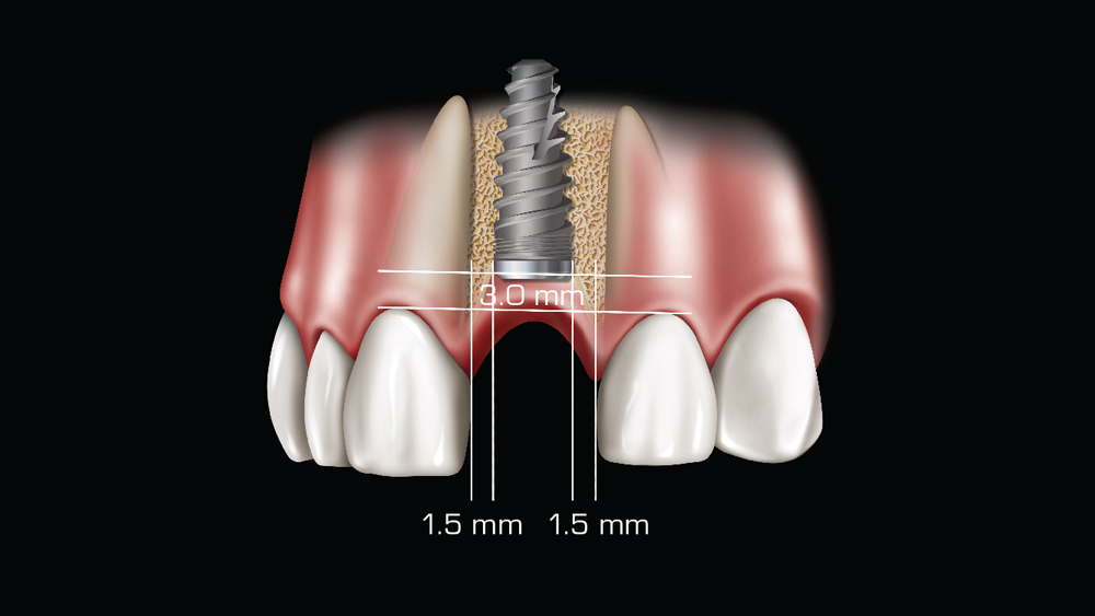 https://images.glidewelldental.com/2017/01/im0704-implant-occlusion2 ...