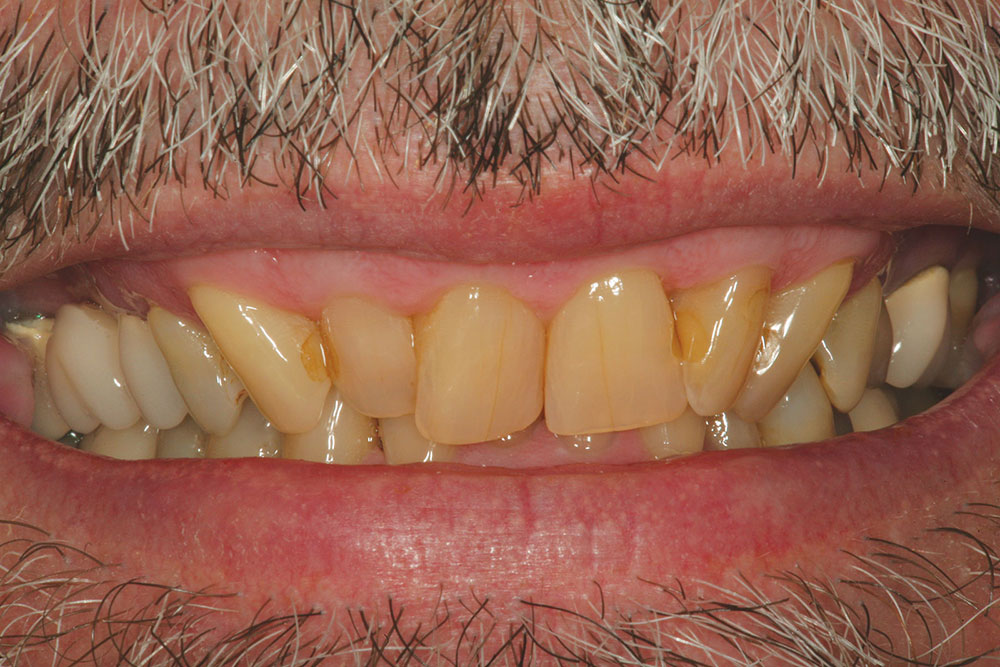 cm0801-prosthetic-tooth-repositioning-15-0