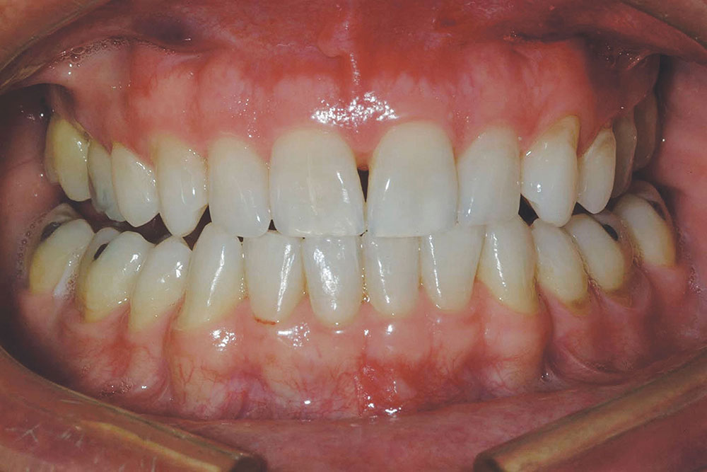 cm0801-prosthetic-tooth-repositioning-10-0